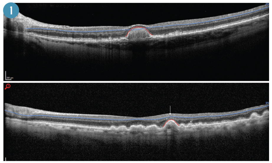 Effect of drusen and atrophy on automated segmentation in OCT images